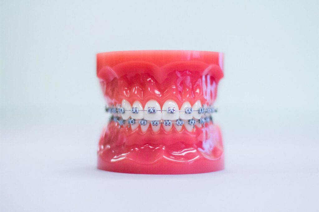 Metal Braces | Servello Orthodontics | Ebensburg Braces